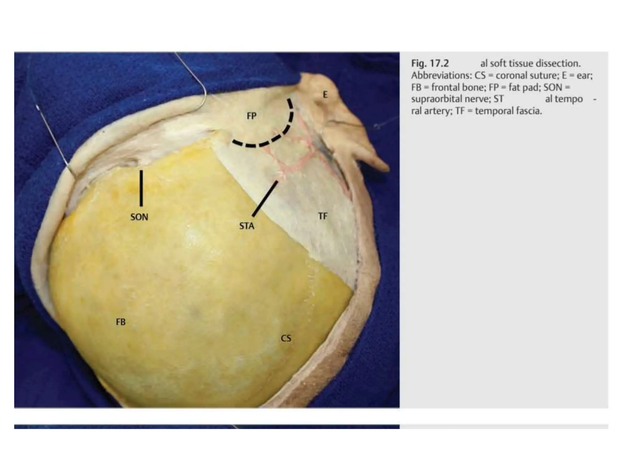 Anatomy of Scalp .by Dr .Saeed ben Aqeel | PPT