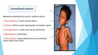 tetanus in children2024/7/23.6435849435.pdf