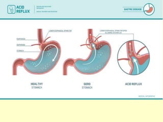 長者常見腸胃病 Elderly Gastrointestinal Problems | PPT