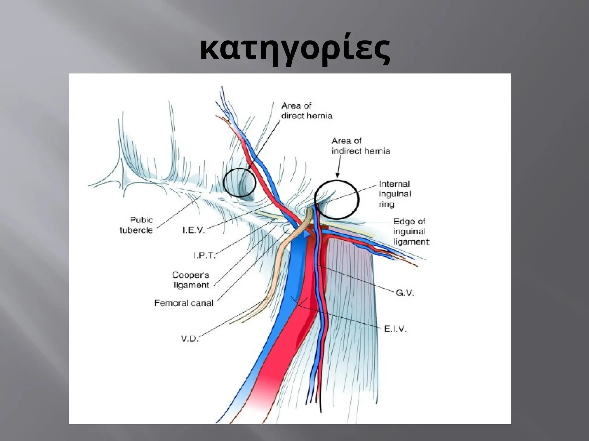 Operations for open Inguinal hernia surgery | PPT