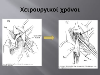 Operations for open Inguinal hernia surgery | PPTX