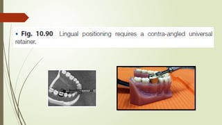 Proximal contact in adhesive dentistry power point | PPT