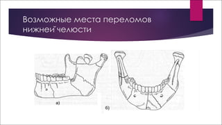 Fracture of lower jaw and its complications | PPT