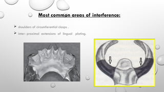 vitallium Removable Partial Denture framework try in | PPTX