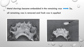 vitallium Removable Partial Denture framework try in | PPTX