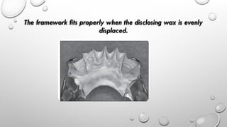 vitallium Removable Partial Denture framework try in | PPTX