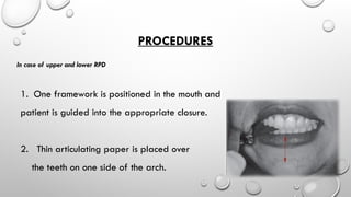 vitallium Removable Partial Denture framework try in | PPT