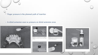 vitallium Removable Partial Denture framework try in | PPTX