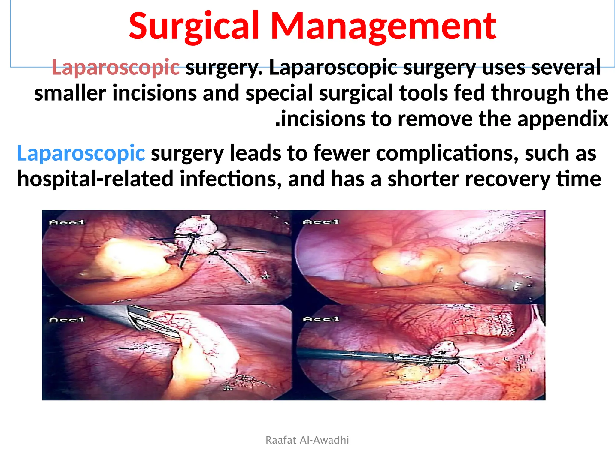 سمنار رافت اخر تعديل رافت. Appendicitis pptx | PPTX