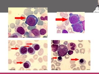 骨髓细胞形态学检查.pdf (Bone marrow cell morphology examination)) | PDF