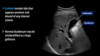 gallbladder anatomy and by Echo arabic version | PDF