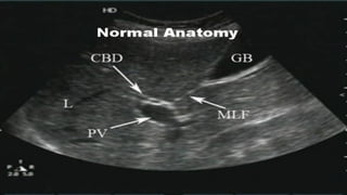 gallbladder anatomy and by Echo arabic version | PDF