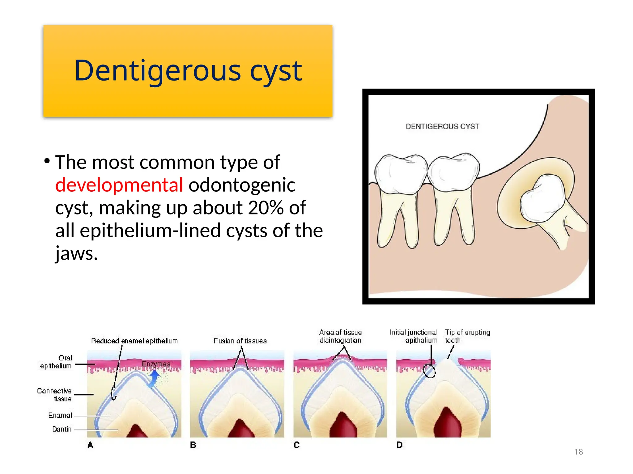 Odontogenic cysts Types histopathology and treatment part 2 | PPTX