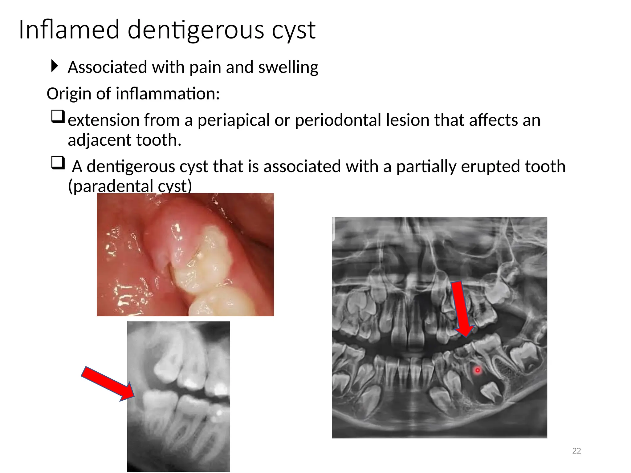 Odontogenic cysts Types histopathology and treatment part 2 | PPTX