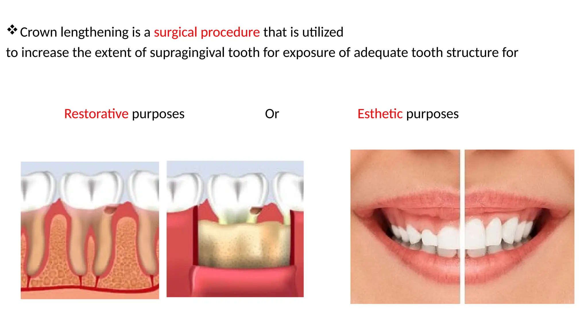 Esthetic crow lengthening surgery تطويل التيجان جراحيا.pptx