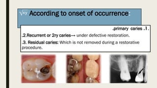 Introduction to dental caries oral pathology | PPTX
