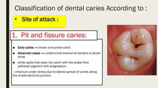 Introduction to dental caries oral pathology | PPTX