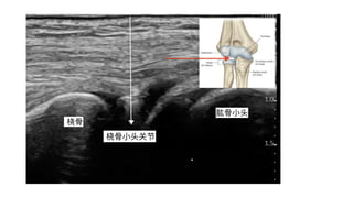 超声引导肘关节注射 Ultrasound-guided elbow joint injection | PPTX