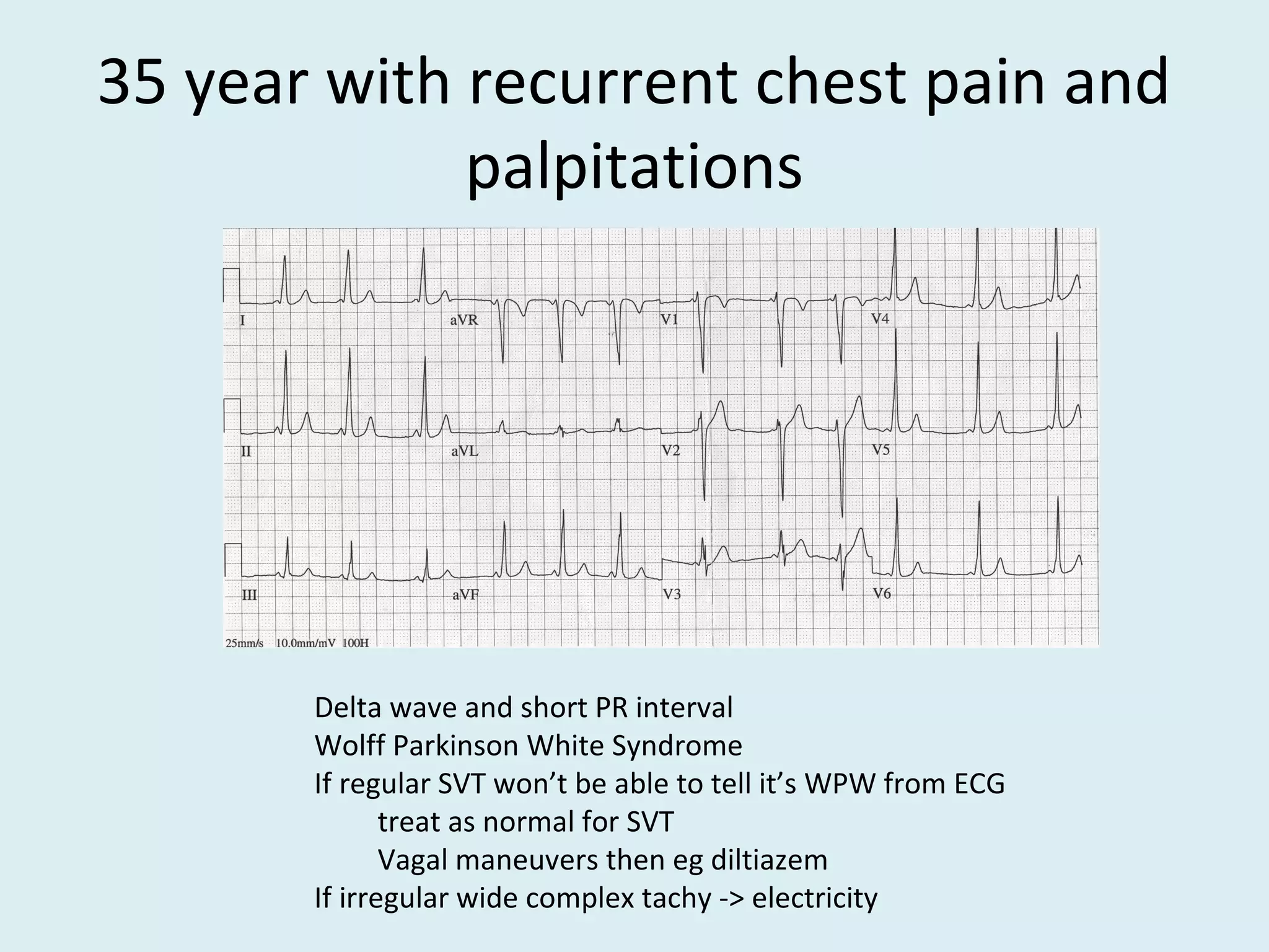 Random ECGs 1 | PPT