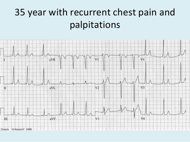 Random ECGs 1