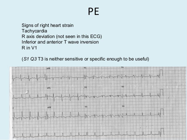 Random ECGs 1