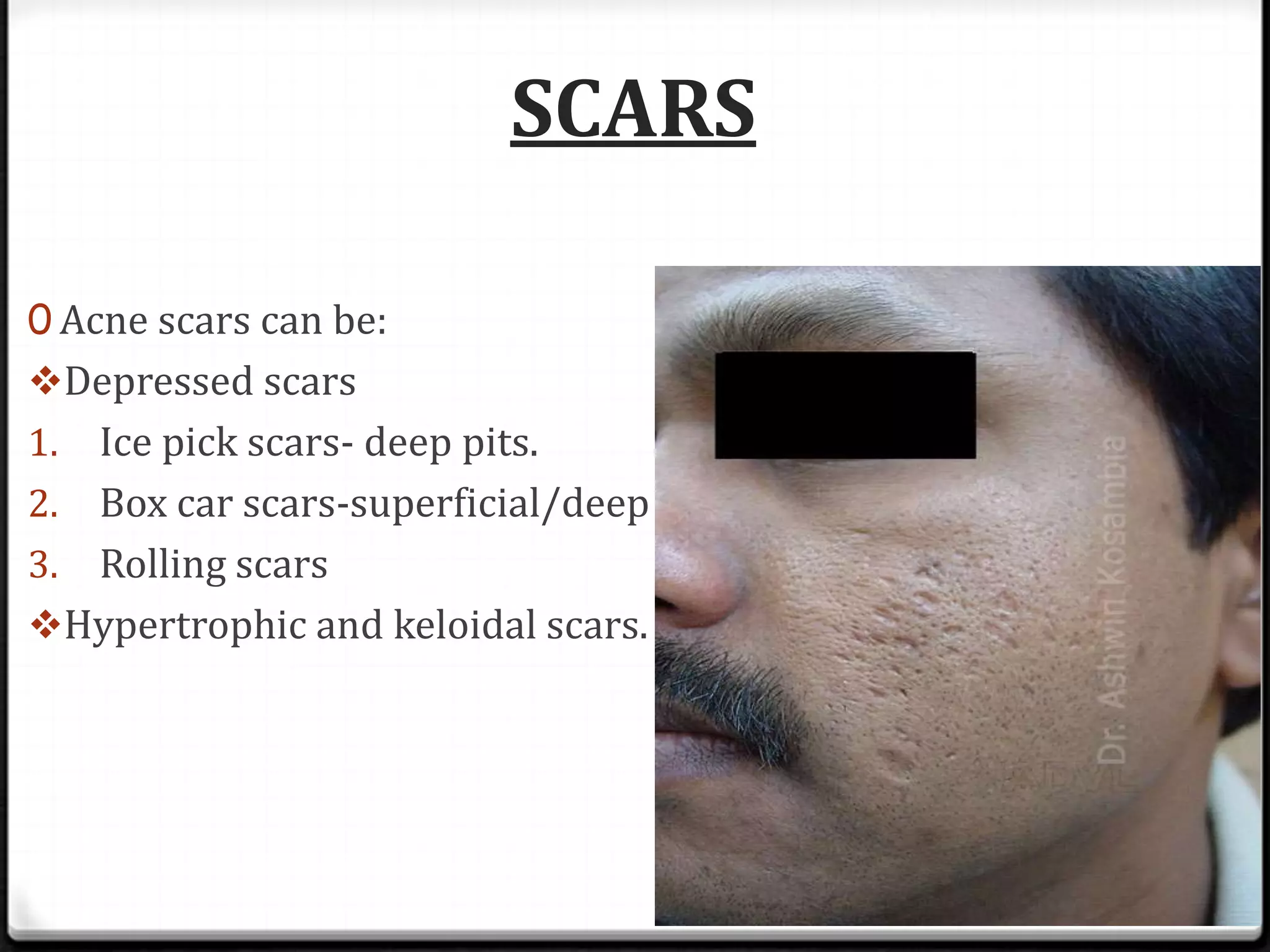 Acne | PPTX