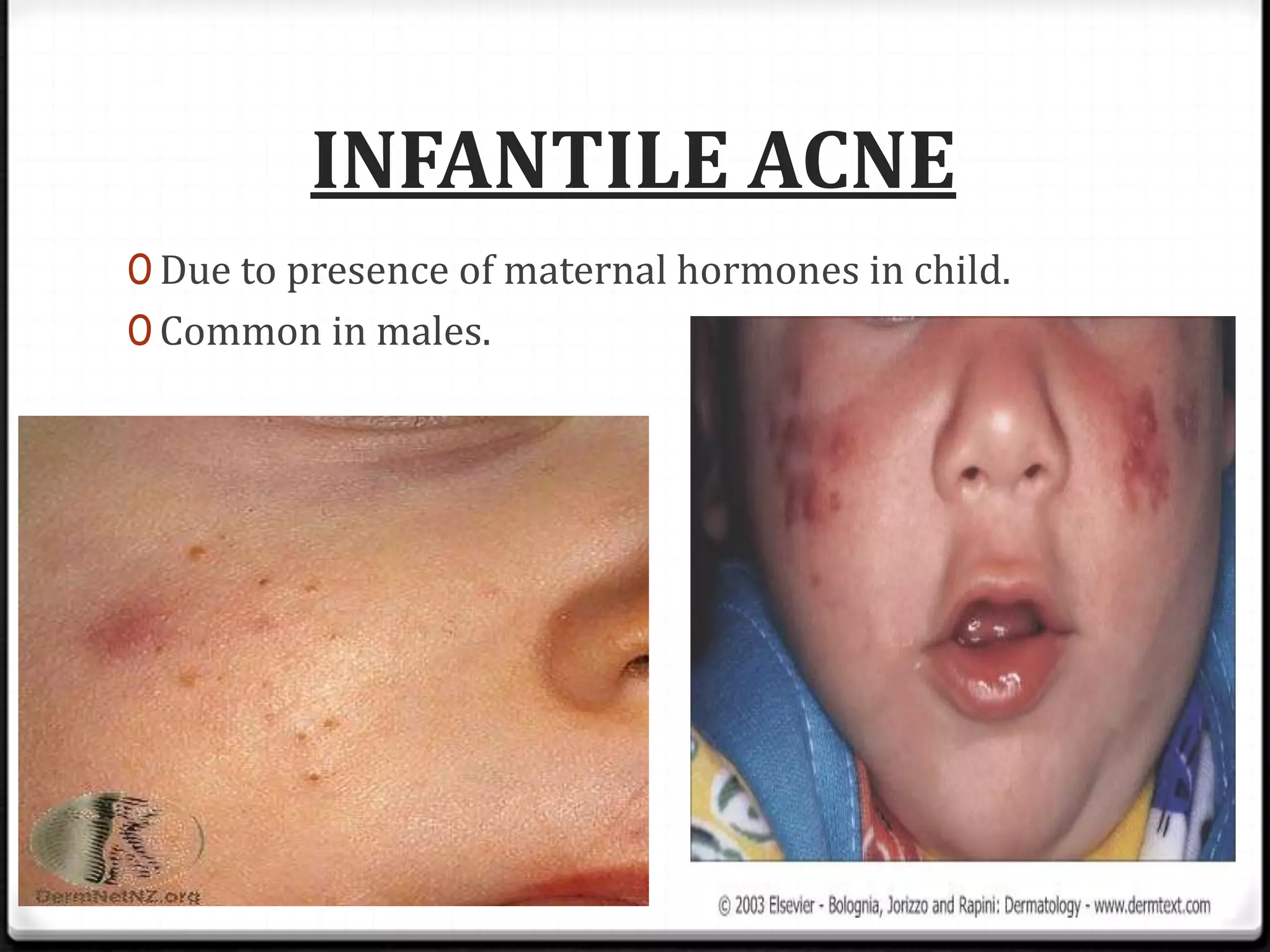 Acne | PPTX