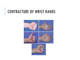 Range of Motion exercises physiotherapy therapeutic exercises .pptx
