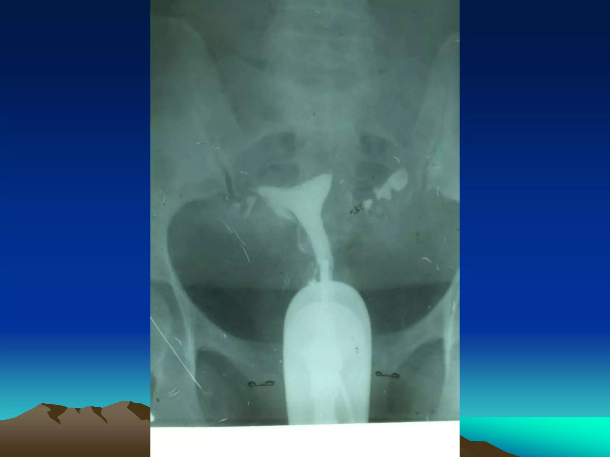 Rania (HSG PPT) (1).ppt | Pregnancy | Reproductive Health