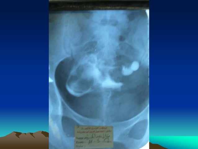 Rania (HSG PPT) (1).ppt | Pregnancy | Reproductive Health