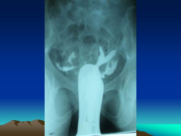 Rania (HSG PPT) (1).ppt | Pregnancy | Reproductive Health