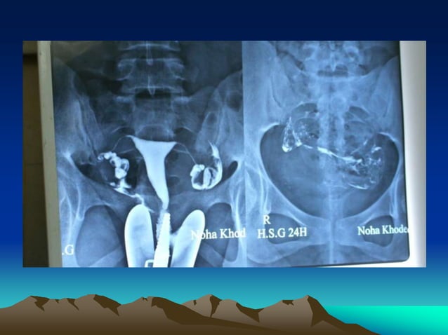 Rania (HSG PPT) (1).ppt | Pregnancy | Reproductive Health