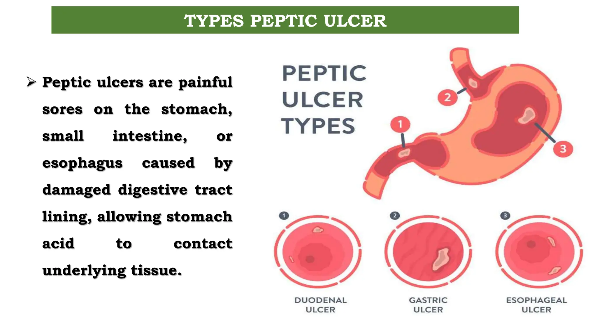 Peptic Ulcer.pptx