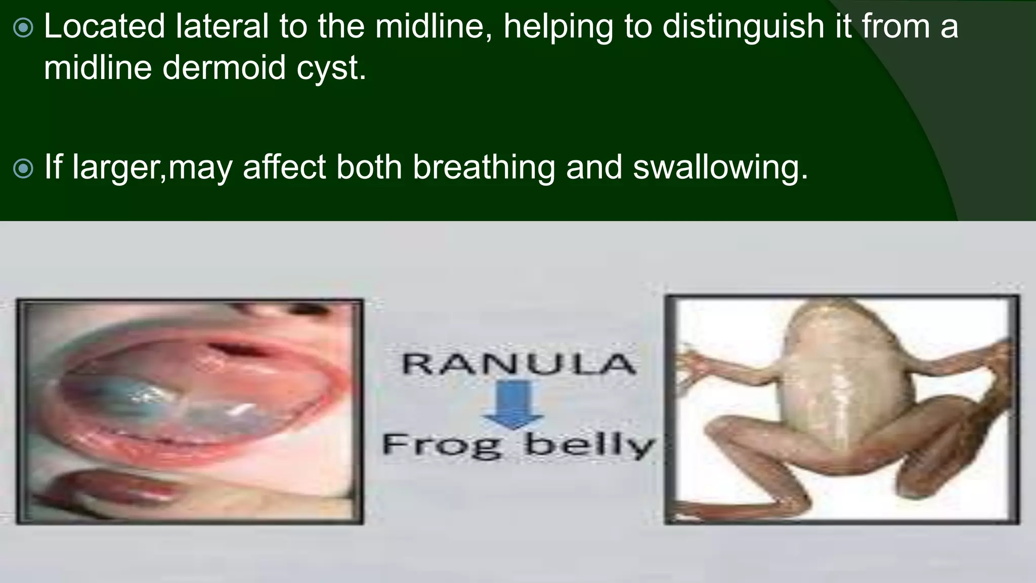 Ranula | PPT