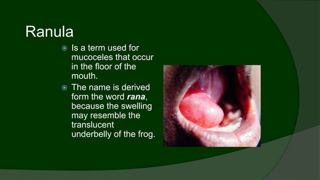 Ranula | PPTX | Ear, Nose and Throat Conditions | Diseases and Conditions