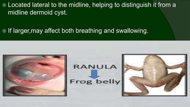 Ranula