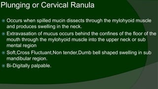 Ranula Pathology Outlines | Cysts and Cyst-like Lesions of the Salivary ...