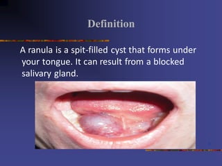 Ranula.Sustemic Surgery,Dental Surgery pdf | PDF