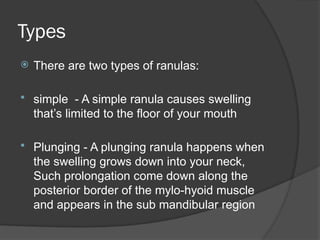 Ranula and its examination -surgery.pptx