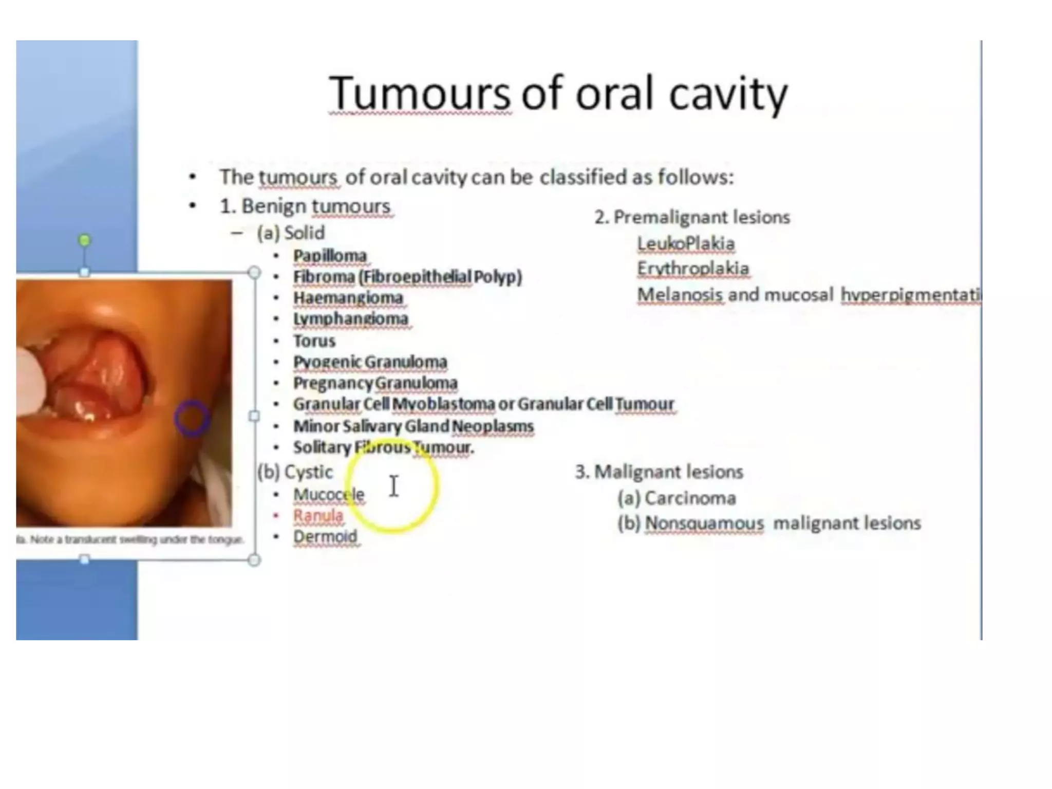 Ranula and plunging ranula | PPTX