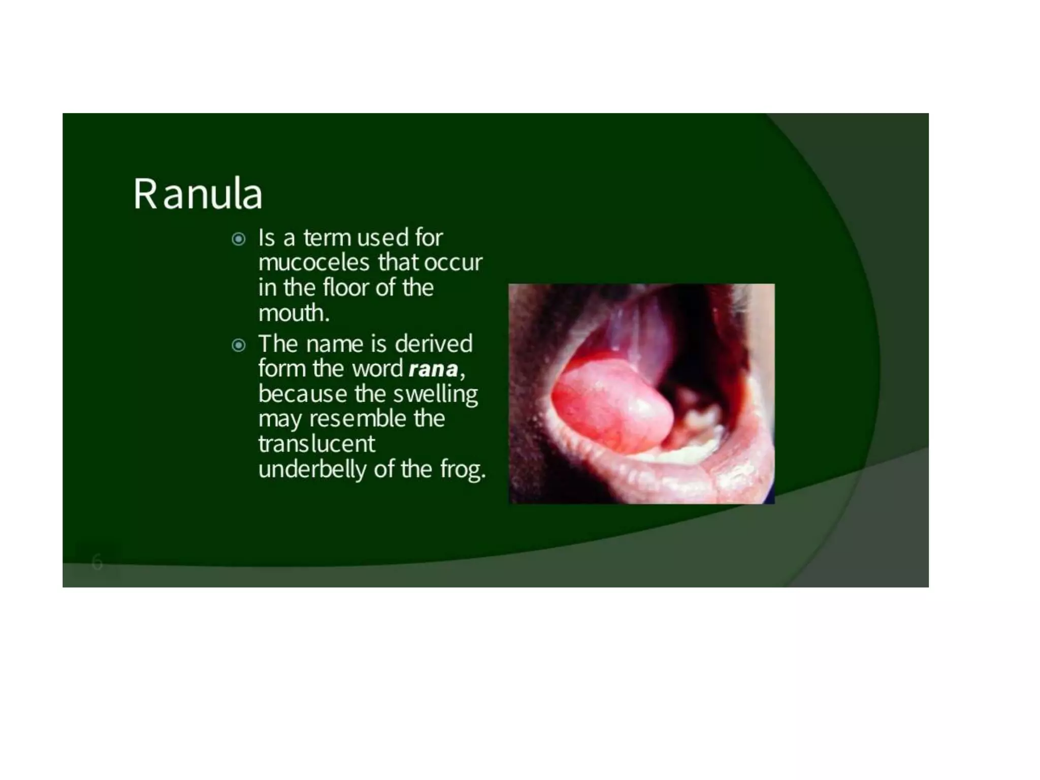 Ranula and plunging ranula | PPTX