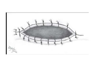 Ranula and plunging ranula | PPTX