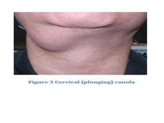 Ranula and plunging ranula | PPTX