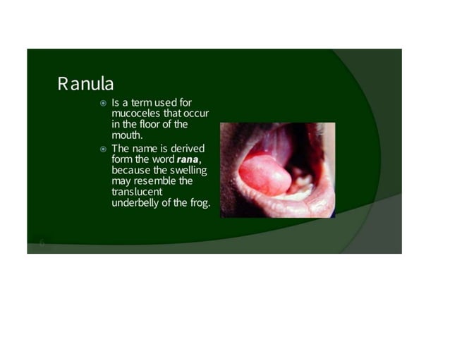 Ranula and plunging ranula | PPTX