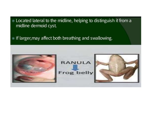 Ranula and plunging ranula | PPTX