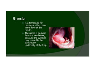 Ranula Neck