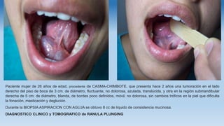 RANULA PLUNGING. | PPTX
