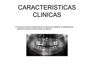 Ranula y mucocele PPT | PPTX