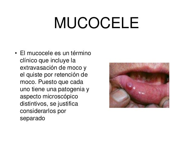 Ranula y mucocele PPT
