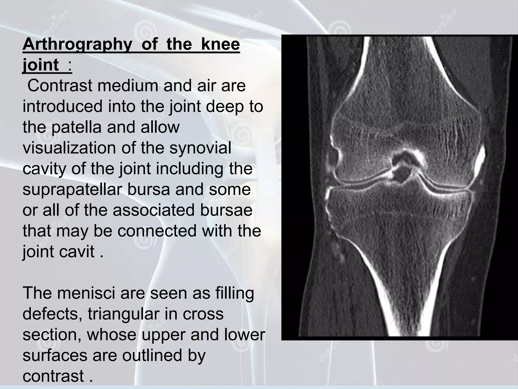 Radiological anatomy of Knee joint.pptx